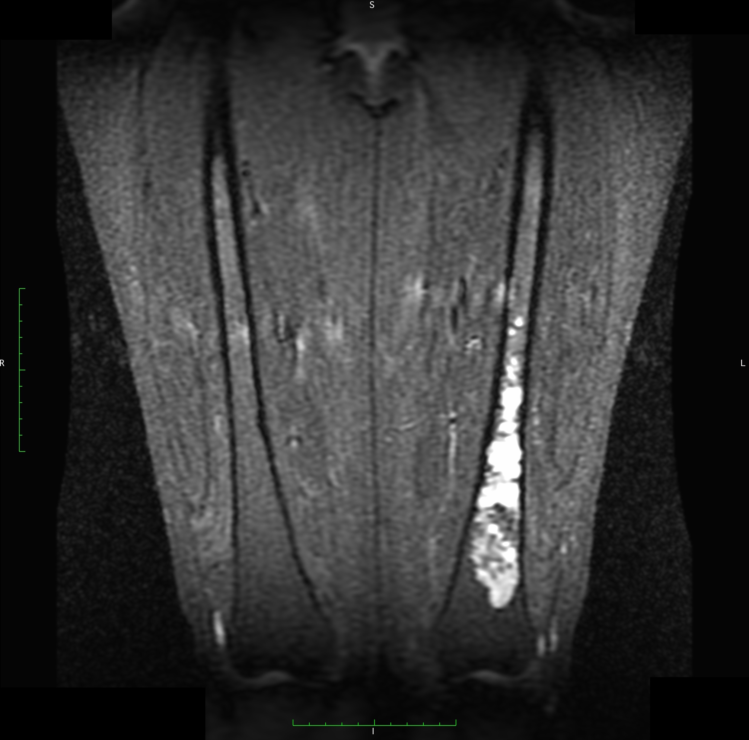 Clear Cell Chondrosarcoma